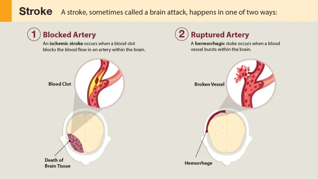 Stroke - RSUD Brebes